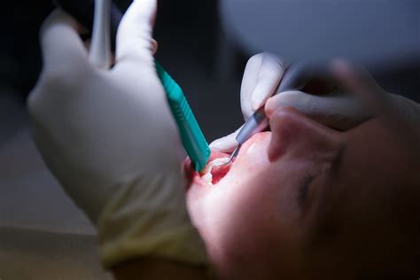 En qué consiste el curetaje dental Clínica Dental del Dr Félix