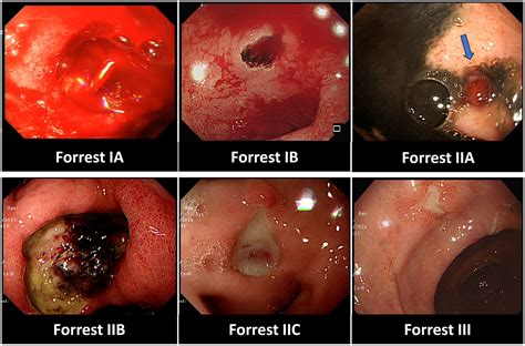 Gastric Ulcer Endoscopy