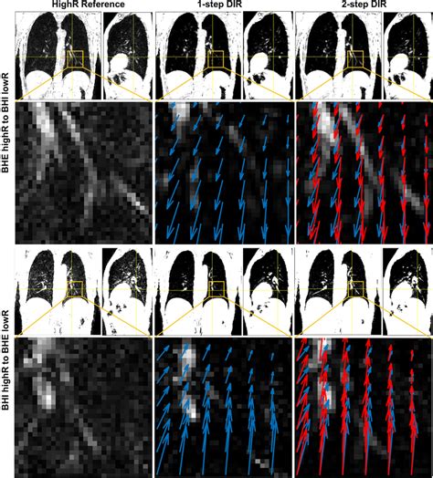 Demonstration Of Improved Lung Bifurcation Alignment Using 2‐step Dir
