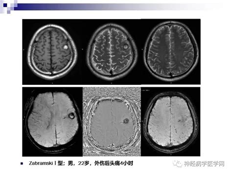 【ppt】脑血管畸形的影像表现—海绵状血管瘤 影像ppt