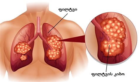 ფილტვის კიბო ჯანმრთელობა Vidal Ge
