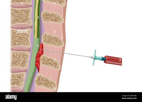 Epidural Blood Patch Procedure Illustration Stock Photo Alamy