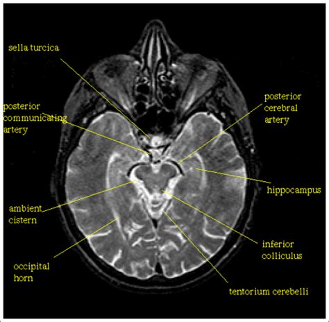 Image Result For Basal Cisterns Medical School Corpus