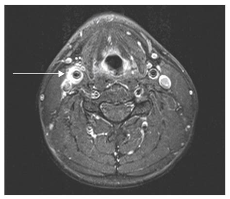 Transient Perivascular Inflammation Of The Carotid Artery European