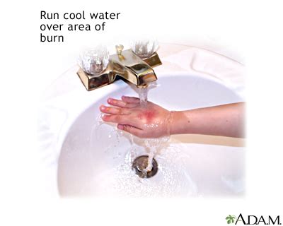 Apply Cold Water Directly To Burned Area