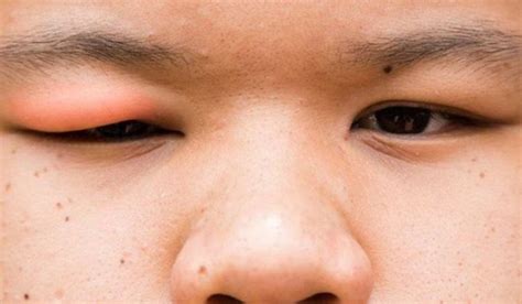Mắt bé bị sưng đỏ mí trên Nguyên nhân Triệu chứng và Giải pháp Hiệu quả