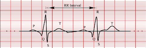 Figure 1 From A Patient Adaptive Profiling Scheme For Ecg Beat Classification Semantic Scholar