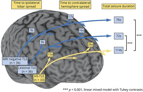 What Is Temporal Lobe Epilepsy
