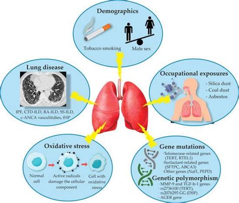 Diana Calaras On Linkedin Combined Pulmonary Fibrosis And Emphysema