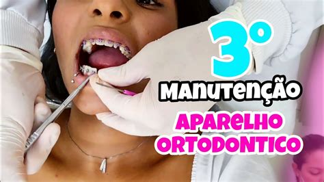3° Manutenção Do Aparelho Ortodontico 🦷🥰 Youtube