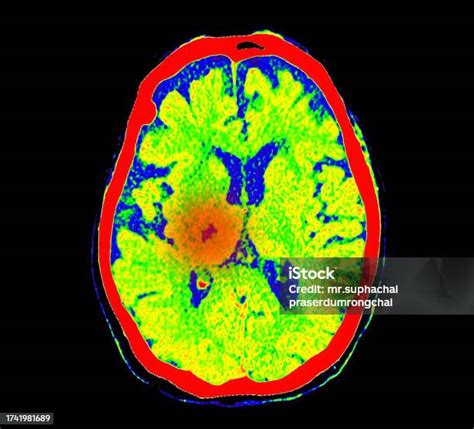 뇌졸중 부위의 모니터에 뇌 혈류를 보여주는 뇌 축의 Ct 뇌 관류 또는 Ct 스캔 이미지 출혈성 뇌졸중에 대한 스톡 사진 및 기타 이미지 출혈성 뇌졸중 뇌졸중 0명