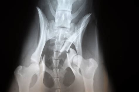 Reemplazo total de cadera Salud en línea