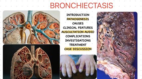 Bronchiectasis Hand Written Notes Youtube