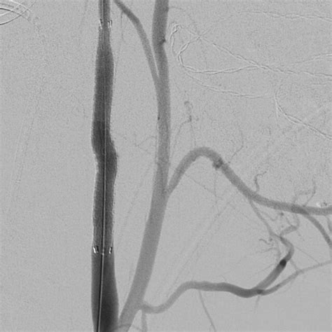 Dsa Demonstrating Successful Left Ica Covered Stent Placement With