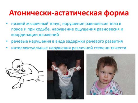 Детский церебральный паралич презентация онлайн