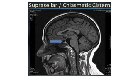 Anatomy Of Subarachnoid Cisterns Of Brain Pptx