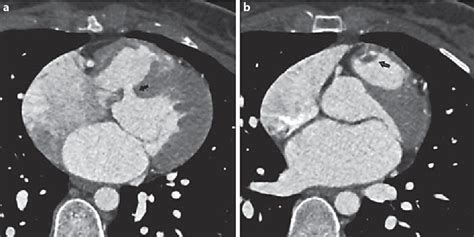 Figure 3 From Isolated Right Sided Mural Infective Endocarditis In A 32