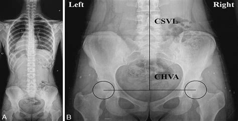 Anatomic Deviation Between The Central Hip Vertical Axis And