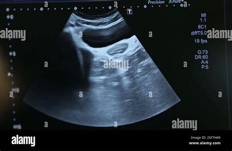 Sonography The Screen Of The Ultrasound Machine Stock Video Footage Alamy