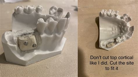 Dental Bone Grafting With Block Allograft Bauer Smiles