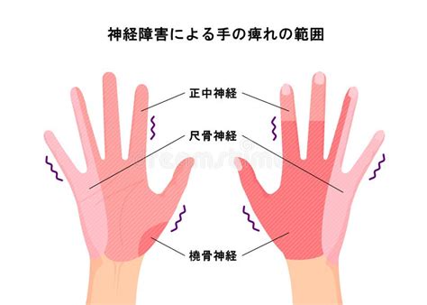 Range Of Hand Numbness Due To Neurological Disorders Stock Vector