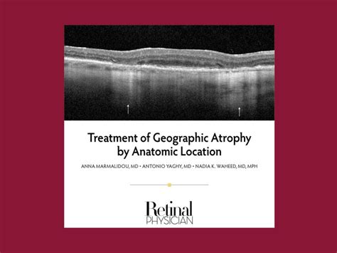 Treatment Of Geographic Atrophy By Anatomic Location Complement… Retinal Physician