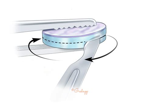 Butterfly Tympanoplasty Oto Surgery Atlas
