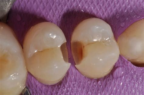 The Actual Extent Of A Grade 3 R3 Carious Lesion Cavity