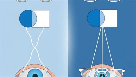 Prism Correction Guide Relief For Double Vision And Headaches