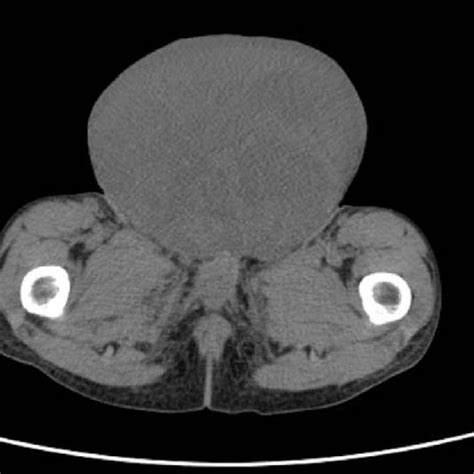 Axial Enhanced Ct Scan Of The Pelvis Showing A Heterogeneously