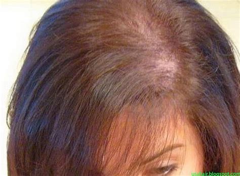Hair Loss In Men And Women Find Out The Difference Between Hair Loss