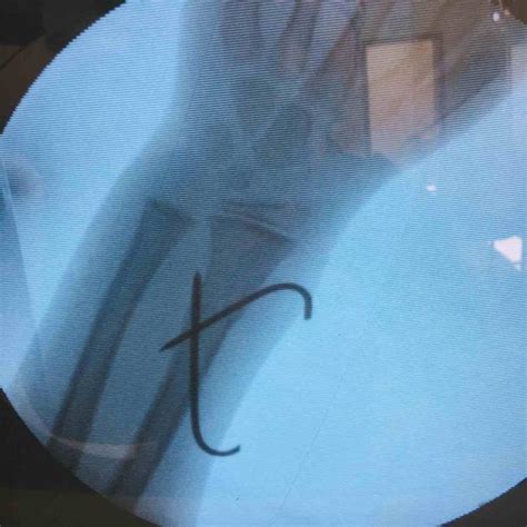 儿童桡骨青枝骨折一例（微创手术） 医联