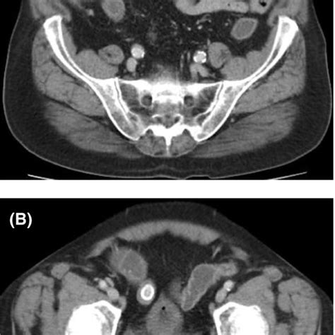Sinogram Showing Contrast Running Up The Right Paracolic Gutter
