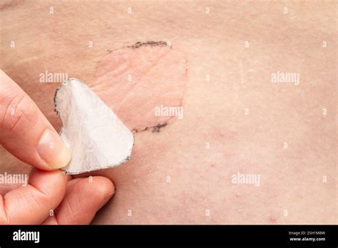 Hormone Replacement Therapy Medication Removing An Evorel 50