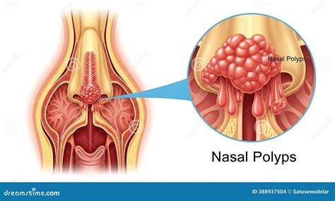 Nasal Polyps Noncancerous Growths On The Lining Of The Nose Or Sinuses Otorhinolaryngology