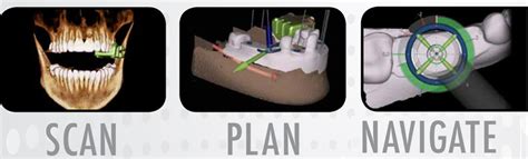 Navigation Implant Surgery Casemasters Blog
