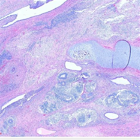 Histologic Imaging Showing Cartilage Glandular And Immature Neural