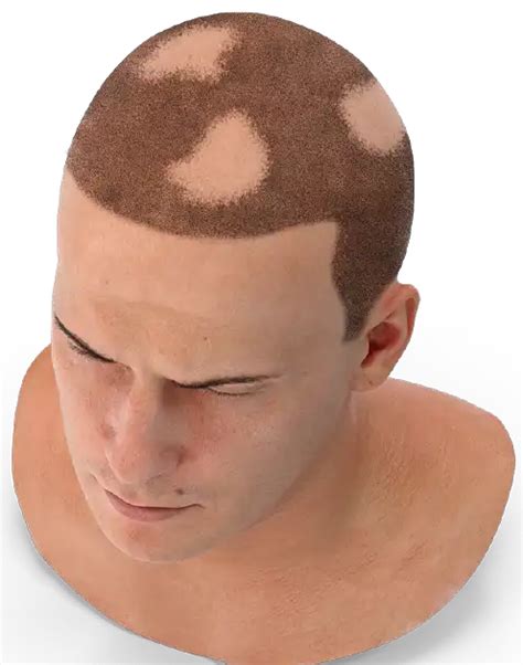 Best Scalp Treatment In Birmingham