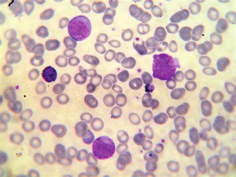 Blasts With Cytoplasmic Blebs And A Basophil Download Scientific Diagram