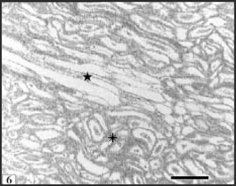 Outer Zone Of Medulla Longitudinal Section Vascular Bundle Of Vasa