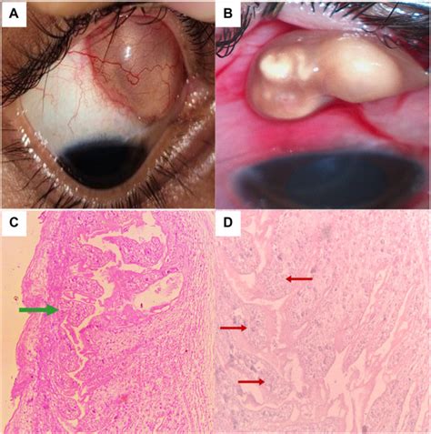 Cysticercus Cellulosae Masquerading As An Encapsulated Bleb Ophthalmology
