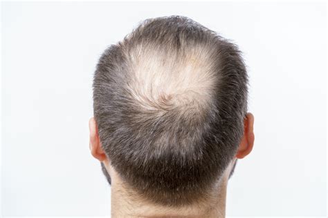 Numankind Which Vitamin Deficiency Causes Hair Loss