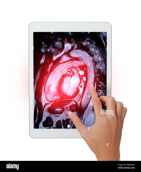 Cardiac Mri Images On Tablet Are Instrumental In Assessing Cardiac Health Identifying Heart