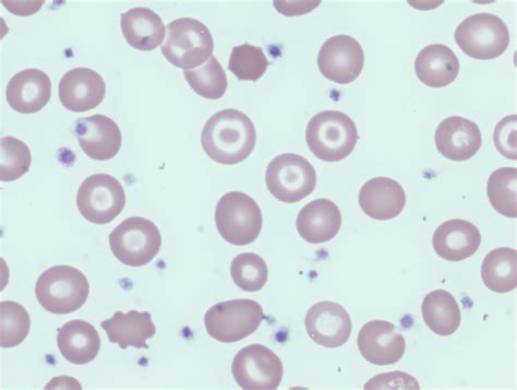 Target Cells Thalassemia