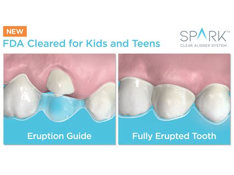 Dt News Us Ormco Announces Fda Approval To Treat Mixed Dentition