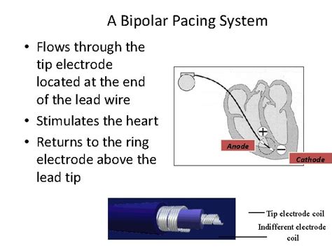 Basics Of Pacemaker Part 1 Dr Suresh S