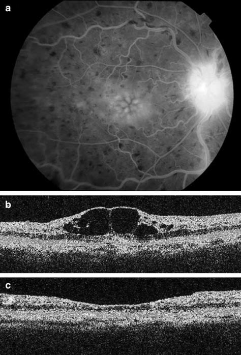 Macular Edema Secondary To Central Retinal Vein Occlusion A