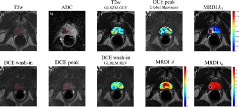 Figure 2 From Prostate Cancer Risk Assessment Using A Radiogenomic