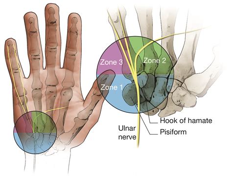 Ulnar Nerve Injury At Wrist Symptoms