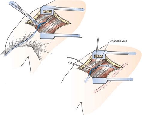 Venous Access The Subclavian Vein And The Cephalic Vein In The